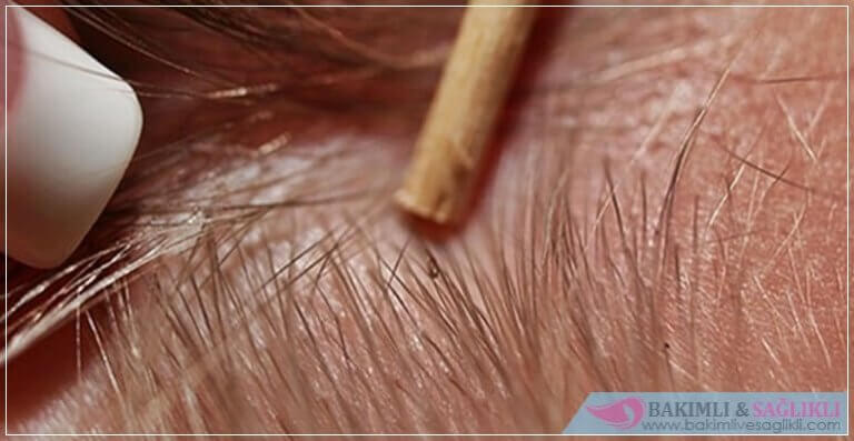 Bit Nedir? Neden Olur Ve Nasıl Çözülür? › Cilt Bakımı